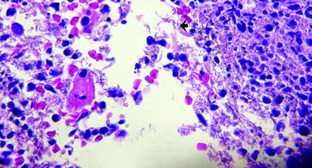 Outlining the STD chancroid: symptoms and prevention